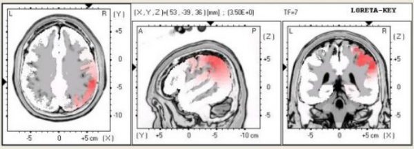 QEEG for Sports Injury and TBI | New York Psychologists